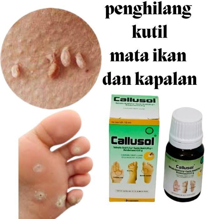 MATA The Newest callusol Wart Medicine herbal Medicine For Removing ...