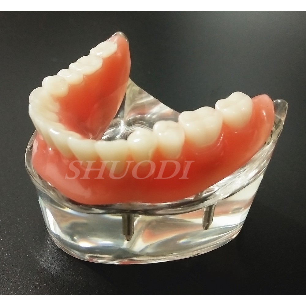 Dental Overdenture Interior Mandibular Lower 4 Implants Restoration ...