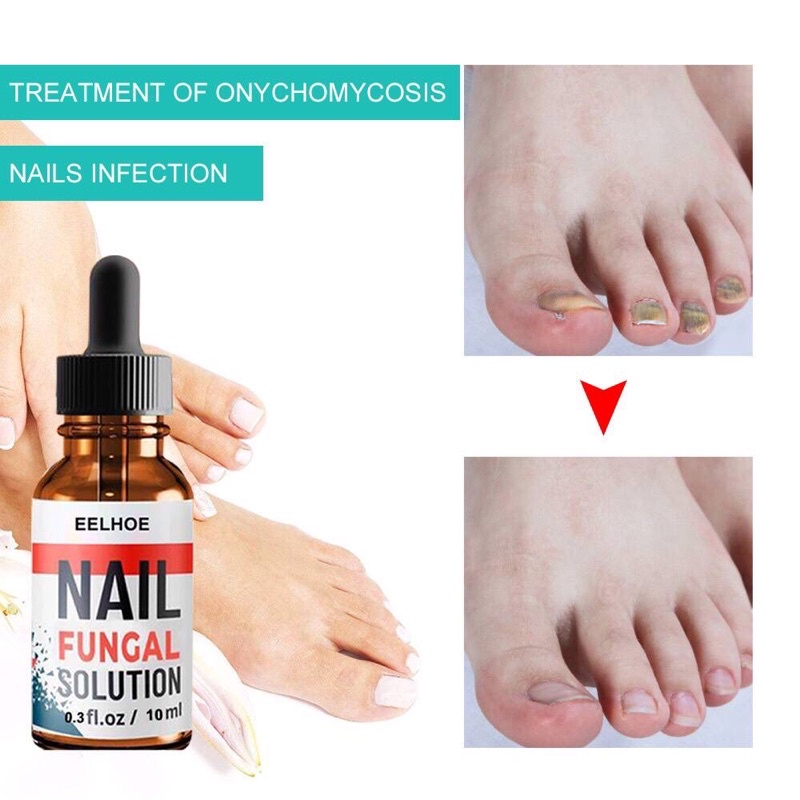 EELHOE NAIL FUNGAL TREATMENT rawat kulat kuku hapus kulat kuku nail ...