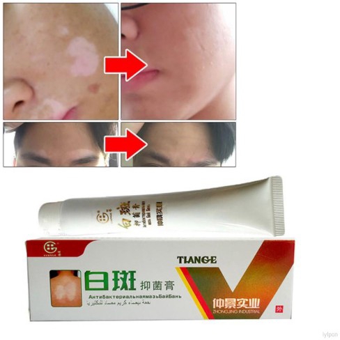 Kd-003 Vitiligo Ointment Vitiligo Medication For White Spots Skin In K ...
