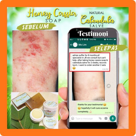 🔥🔥 SET A: SABUN & KRIM EKZEMA,Gatal-Gatal, ,Kurap,Psoriasis, Kudis ...