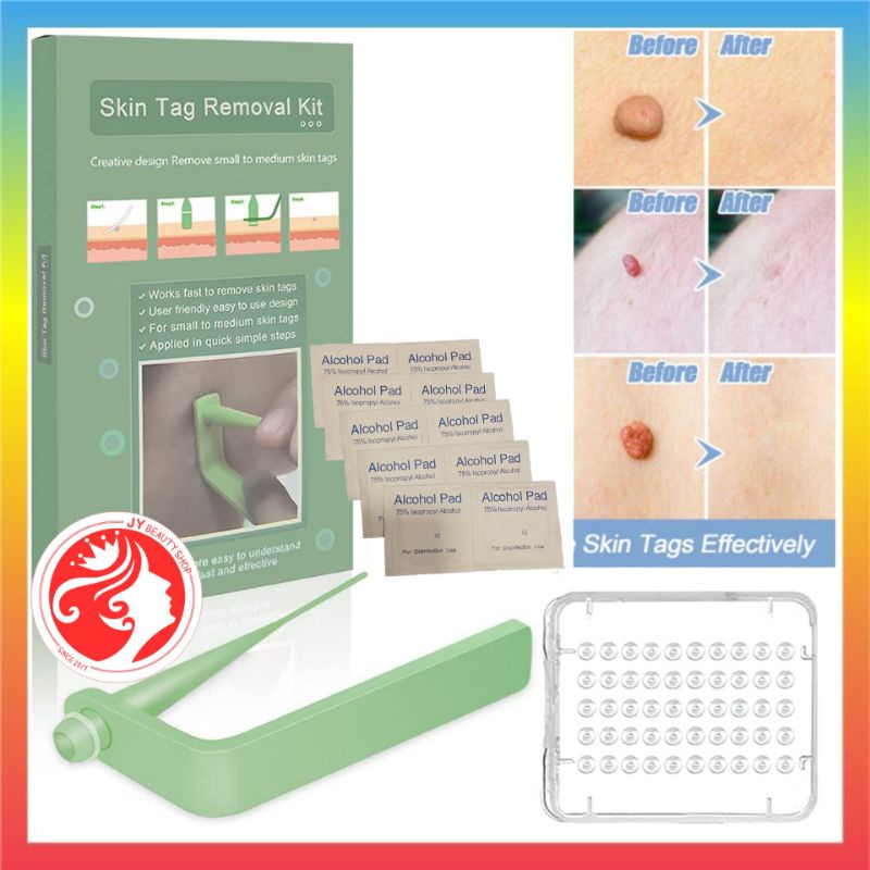 Medical Skin Tag Removal Kit Skin Wart Remover Skin Tag Remover Kit ...