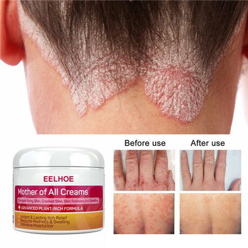 30g EELHOE Skin Psoriasis Cream Dermatitis Eczematoid Eczema Ointment ...