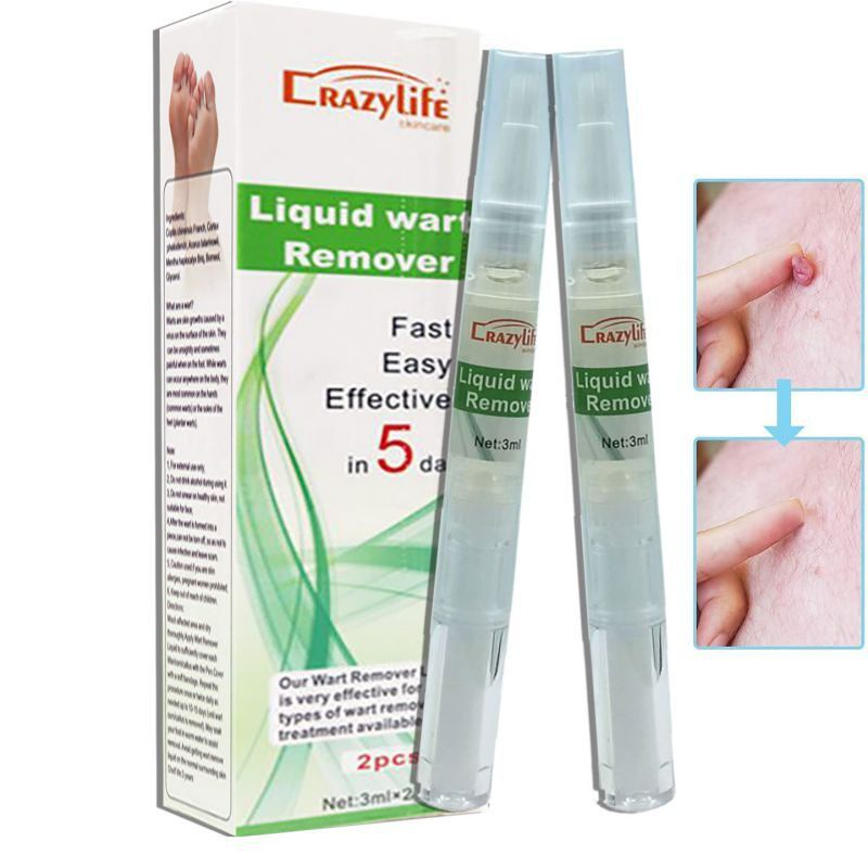 Crazylife Liquid Wart Remover Pen Natural Mole Nevus Wart Skin Tag Foot ...