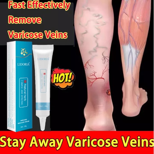 RL Varicose Veins Treatment Cream Phlebitis Pain Relief Ointment spider ...