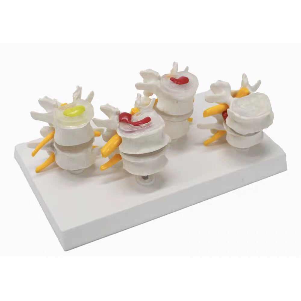 *ship from m'sia* Life-Size Human Normal Lumbar Vertebrae Model ...