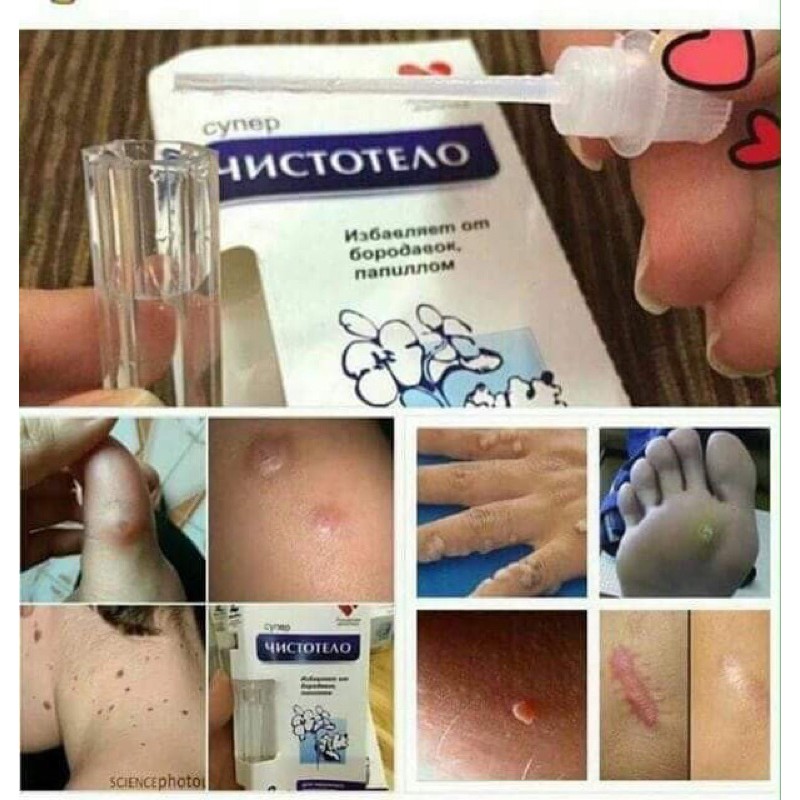 Mole and Mole Spot Gel (Genuine, Effective, Economical) | Shopee Malaysia
