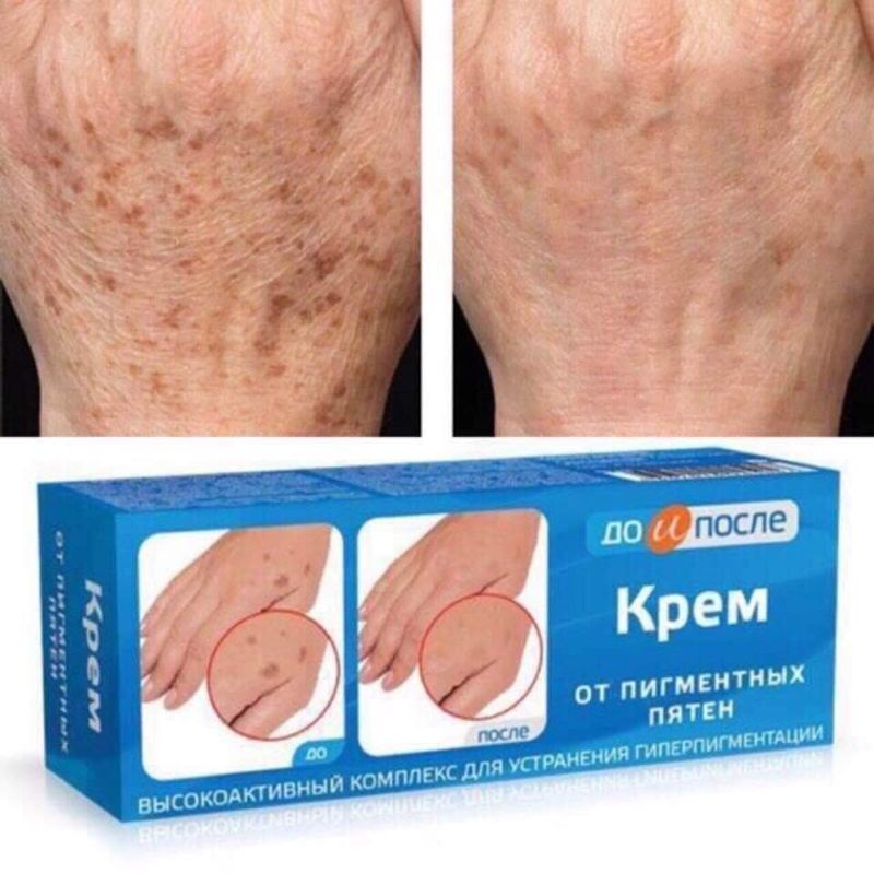 KPEM Age Spots Dark Spots Brown Spots Hand Skin Care Cream | Shopee ...