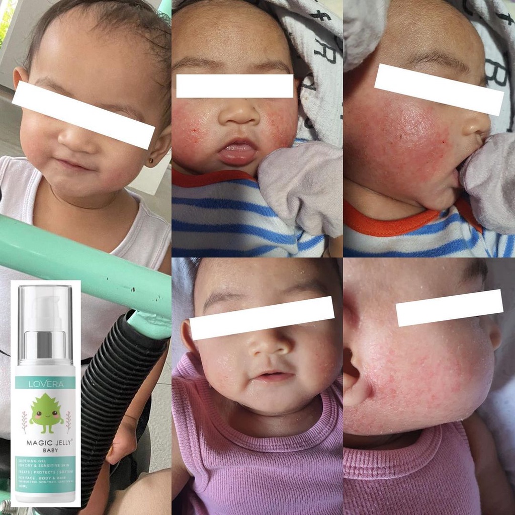 Magic Jelly Baby (Eczema baby,kulit gatal,kulit kering, ruam lampin ...