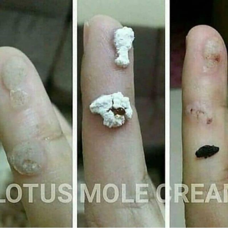 🔥 HOT ITEM🔥 Lotus Mole Cream (Krim Buang Tahi Lalat, Ketuat, Skin Tag ...