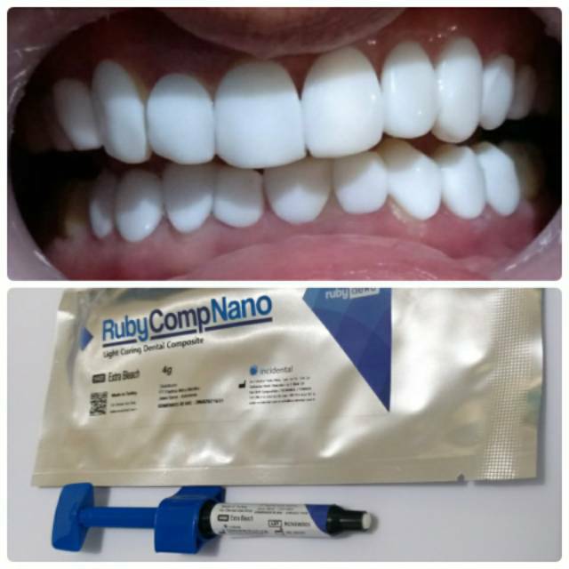 Composite Ruby Comp Nano Veneer EW (Extra Bleach), A1, A2, A3, B1 4gram turkey | Shopee Malaysia