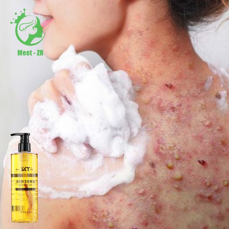 Acne body wash suppress itching Antibacterial Mite removal Anti Mite sabun jerawat badan Eczema ...