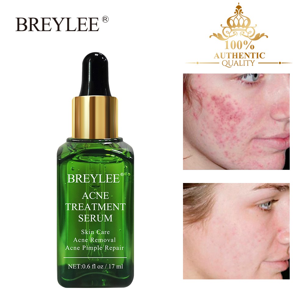 BREYLEE Acne Treatment Serum Anti Acne Scar Removal Cream Whitening Repair Pimple 17ml | Shopee ...