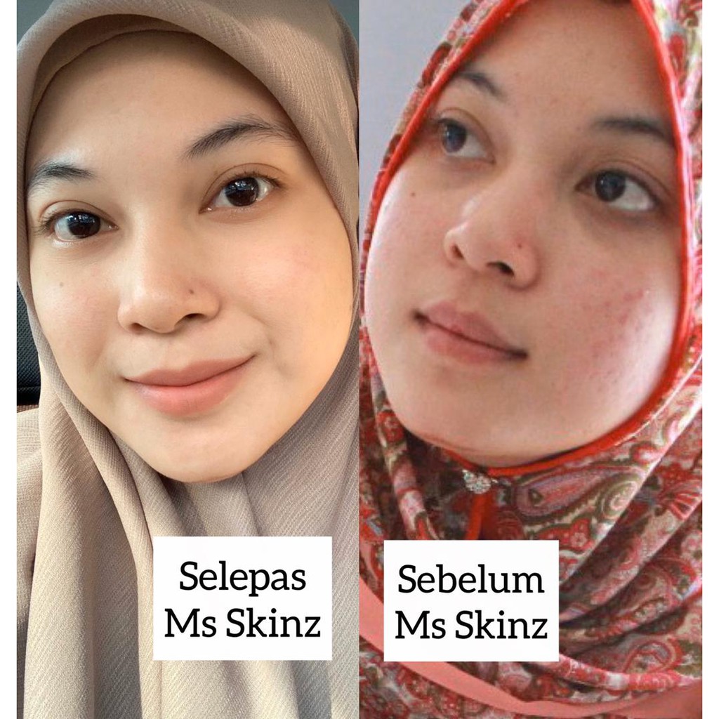 KRIM GO BEAUTY MS SKINZ BY EZANY KRIM MUTIARA TREATMENT JELITA UOLLS ...