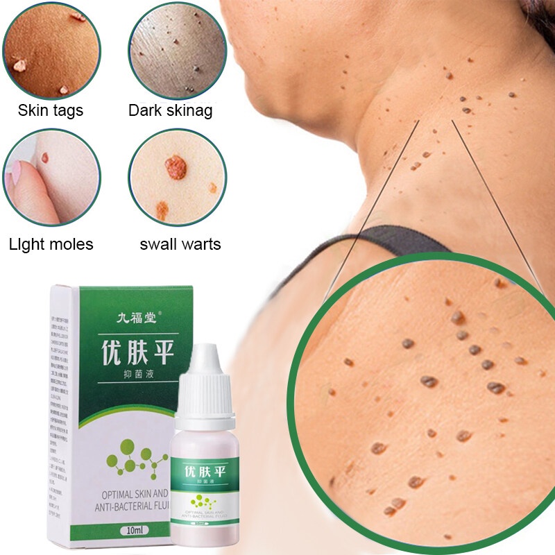 ubat kutil tahi lalat ketuat dan biji kolesterol ubat ketuat tapak kaki ...