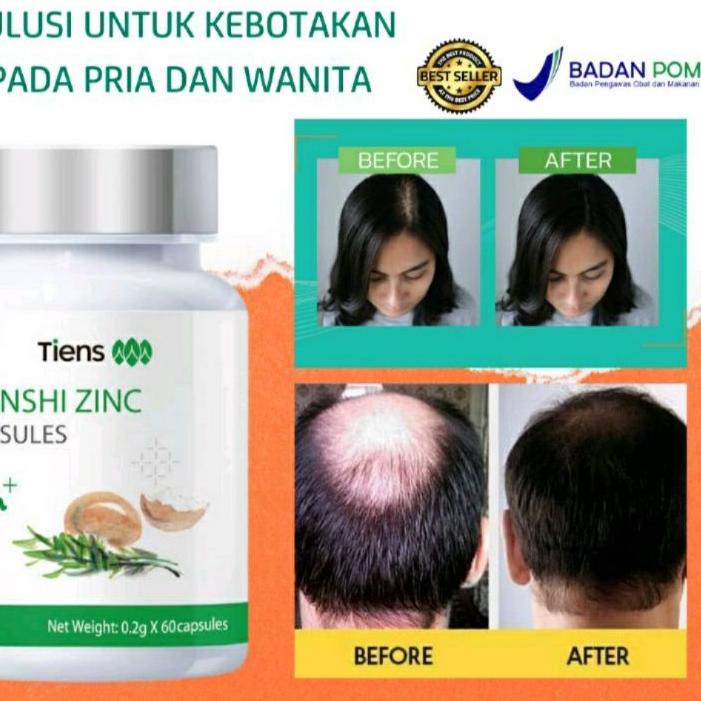 Can COD Most LARIS Hair Ground HORMON ZINC TIENS!!! Hair Great, BREWOK ...