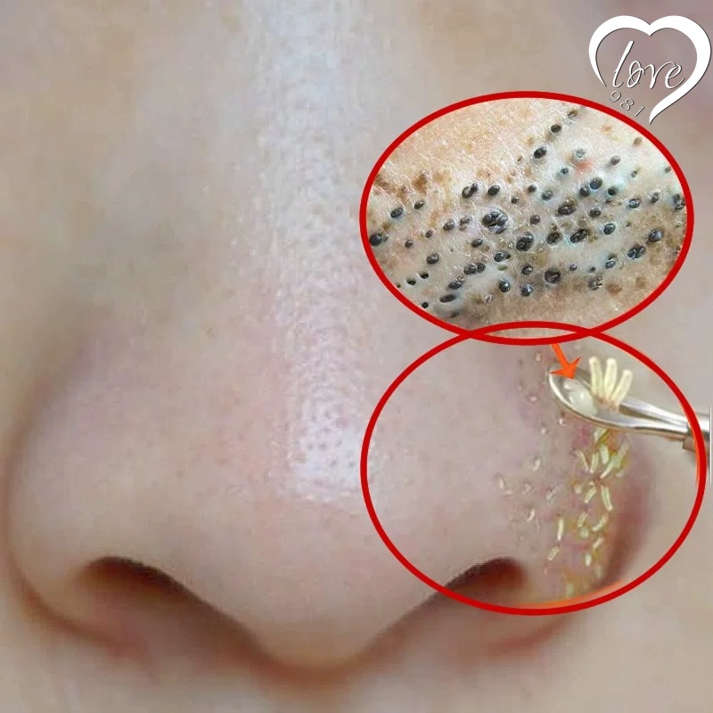 1PC spot blackhead nasal patch, nasal patch, tear-off, blackhead ...