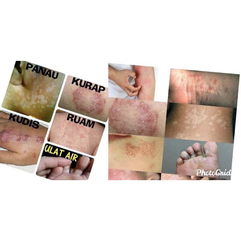 SALAP SELUBI ! UBAT KURAP , KAYAP DAN PANAU PALING MUJARAB | Shopee ...