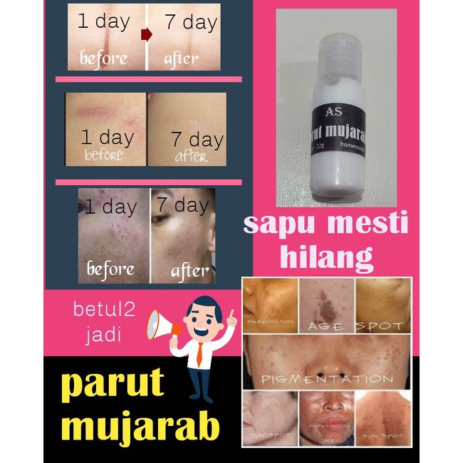 parut mujarab. ,krim parut,parut mujarab,parut lama,parut baru,krim ...