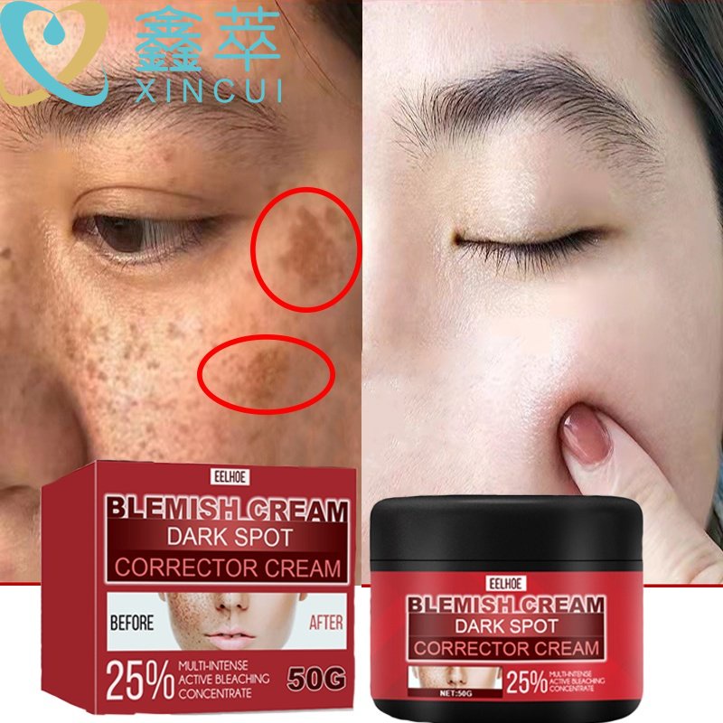 EELHOE Anti-Freckle Stubborn freckle cream treatment freckle skincare ...