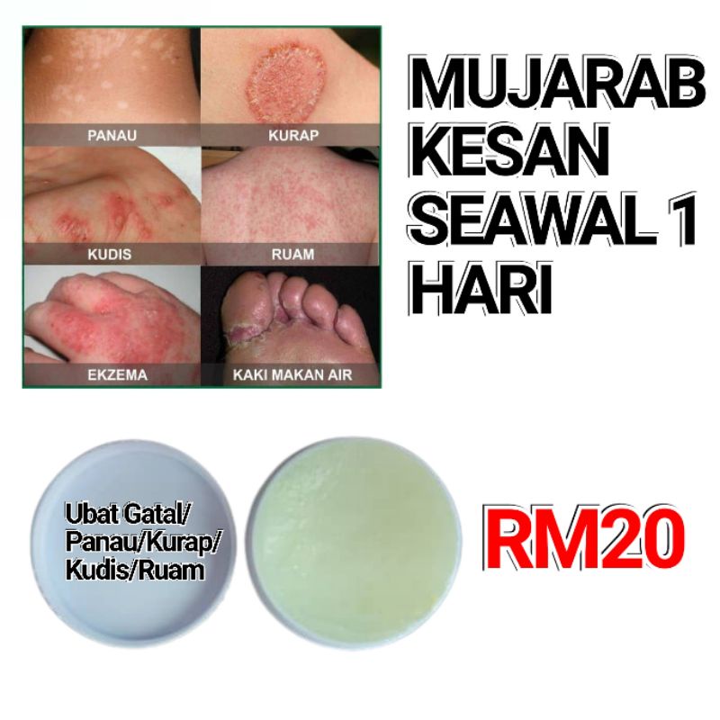 Mujarab Kesan Seawal 1 Hari Ubat Gatal Panau Kurap Kudis Ruam Ekzema ...