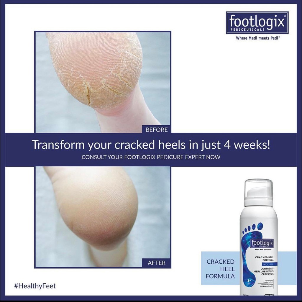 FOOTLOGIX Cracked Foot Revitalizing Mousse Dry Feet Nourishing Mousse ...