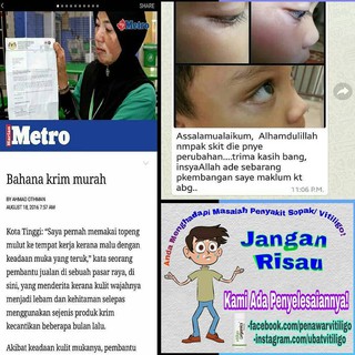 Penawar Penyakit Sakit Sopak/ Vitiligo- Vitiligo Organics Naturally ...