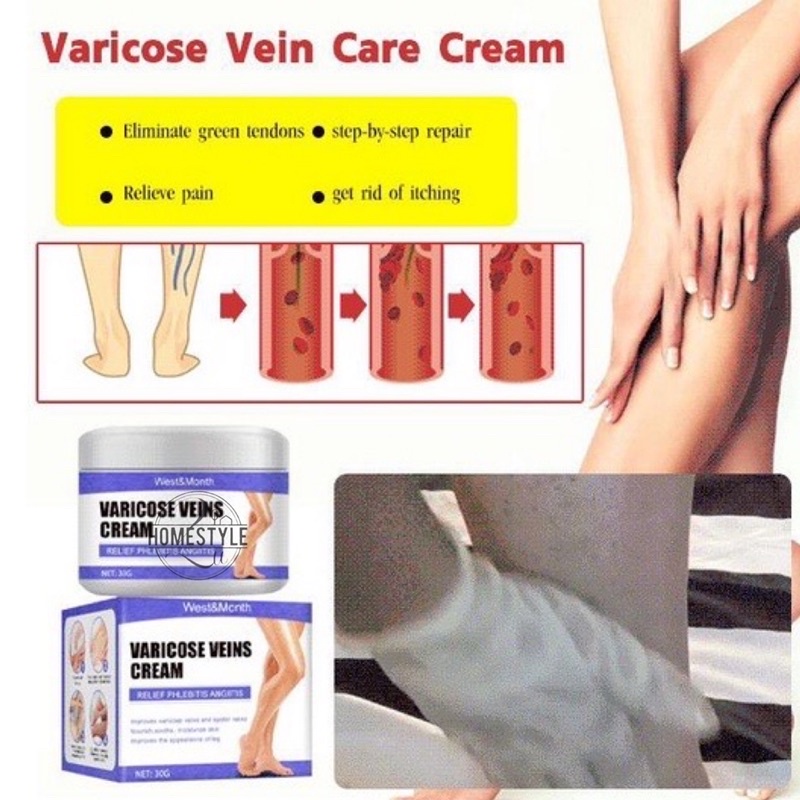 West&Month Varicose Vein Care Cream Health Care Cream RELIEF PHLEBITIS ...