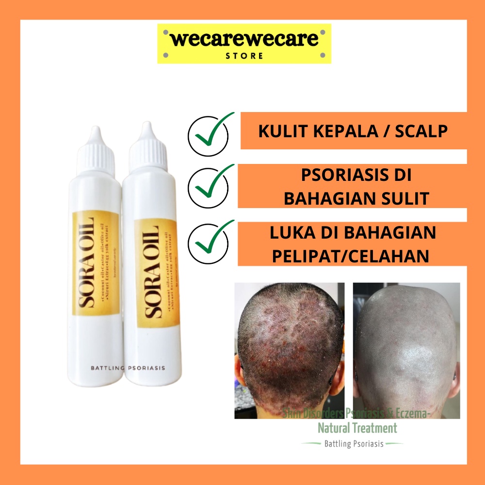 Sora Oil Soraoil Battling Psoriasis/Minyak telur/ Egg oil/ [Rawat ...