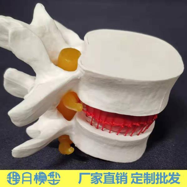 Human Spine Lumbar Intervertebral Disc Protrusion Model Magnification ...