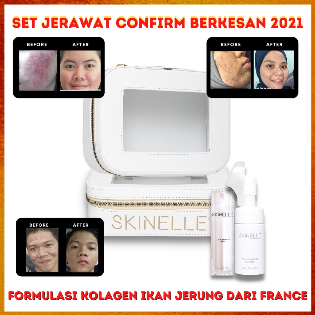 SKINELLE Set Skincare Jerawat Kolagen Ikan Jerung 99% Berkesan | Shopee ...