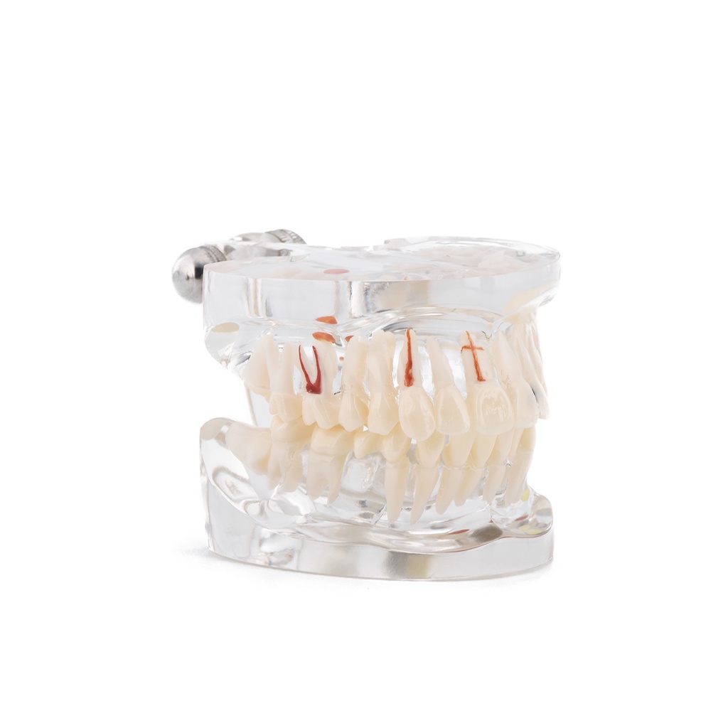 Dental tooth pathology model adult full mouth tooth model dental model ...