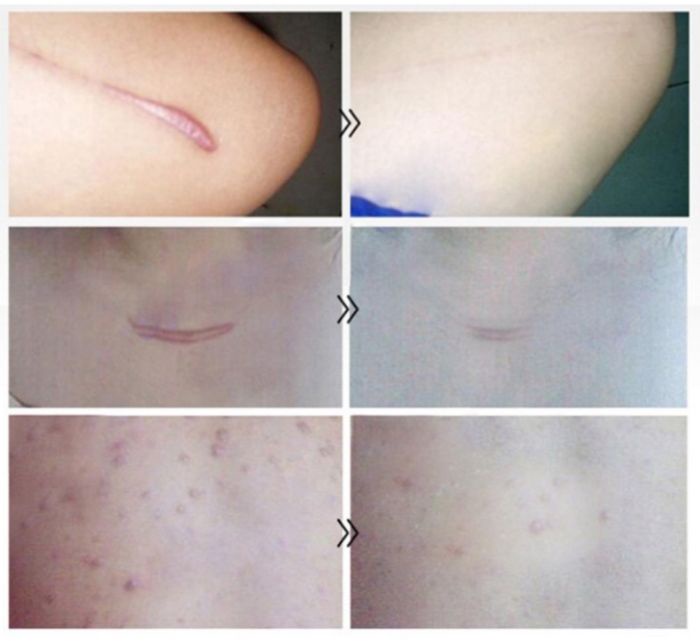 Scar Gel/ Scar Cream/ Parut Jerawat/ Stretchmark/ Skin Repair ...