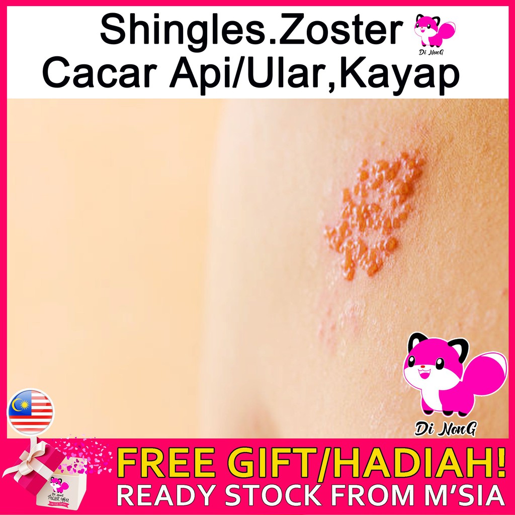 Krim Kayap Herpes Cacar Api/Ular Shingles Zoster Cream | Shopee Malaysia