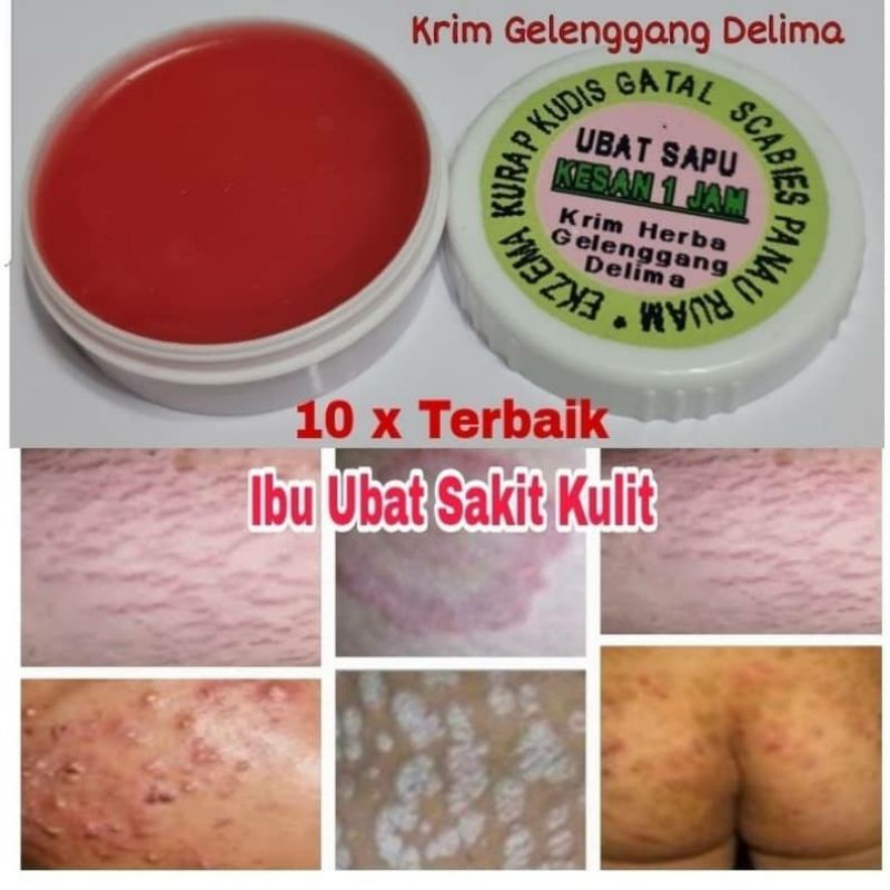 Super ubat Krim Gelenggang + Pati Delima untuk sakit kulit ekzema panau ...