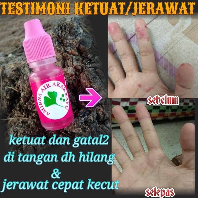 AMIRNA AIR AKAR KAYU UBAT RESDUNG/KUKU CEKAM AIR & MASALAH KULIT(1PCS ...