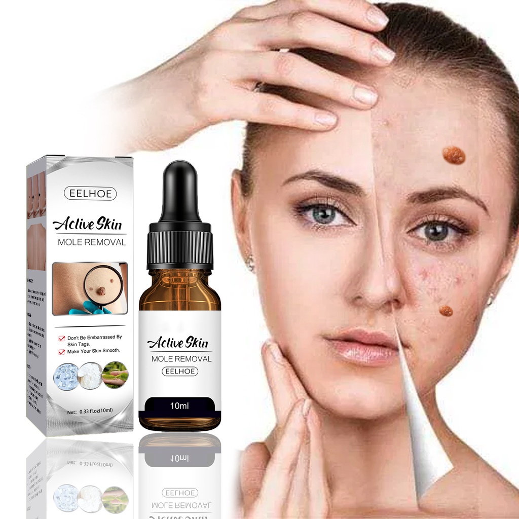 Mole Skin tag Remover Warts Essential oil Lightening Melanin Dark Spots ...