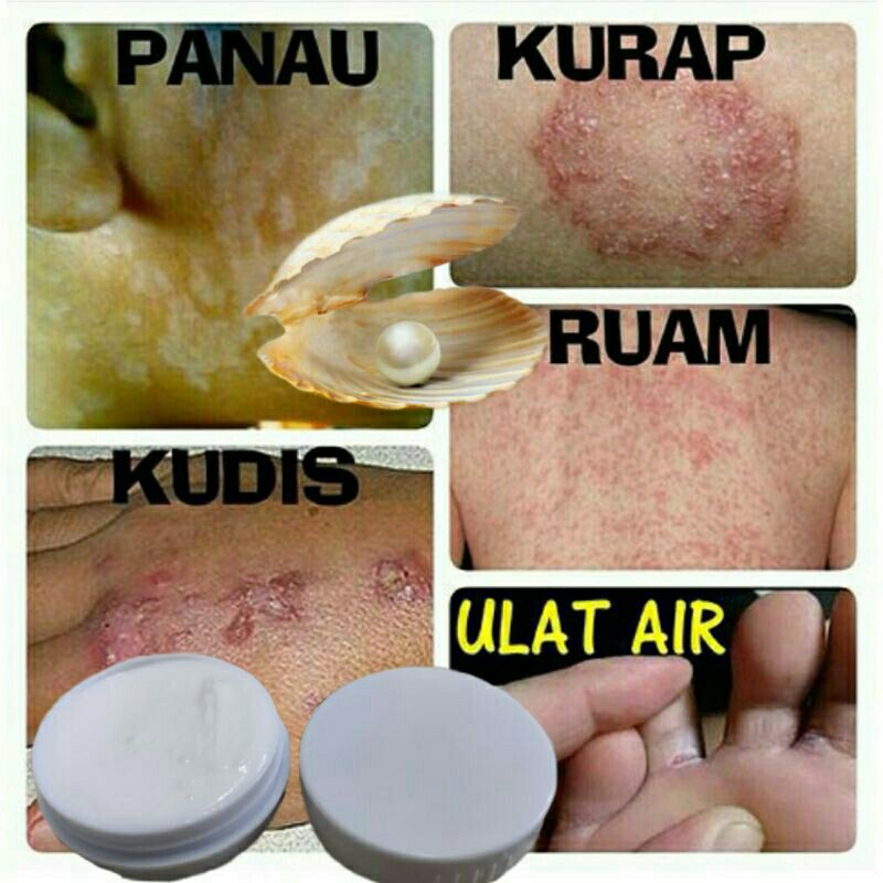 Krim Mutiara (gatal,ekzema,kurap,ruam,panau,kudis,ulat air) | Shopee ...