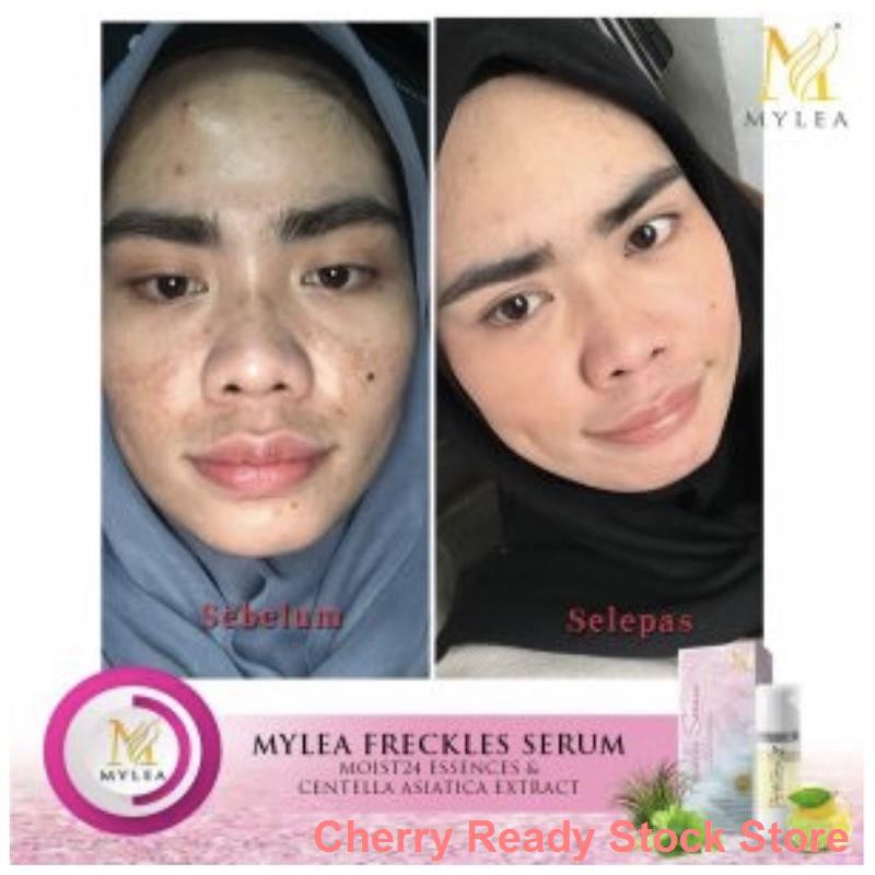 🔥 ORIGINAL 🔥 MYLEA FRECKLES SERUM & BAR 🔥 MYLEA SERUM 🔥 MYLEA BAR | Shopee Malaysia