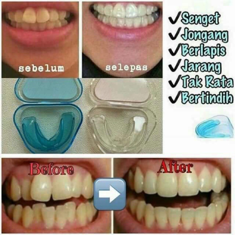 TEETH TRAINER Jom cantikkan gigi senget jonggang berlapis bertindih ...