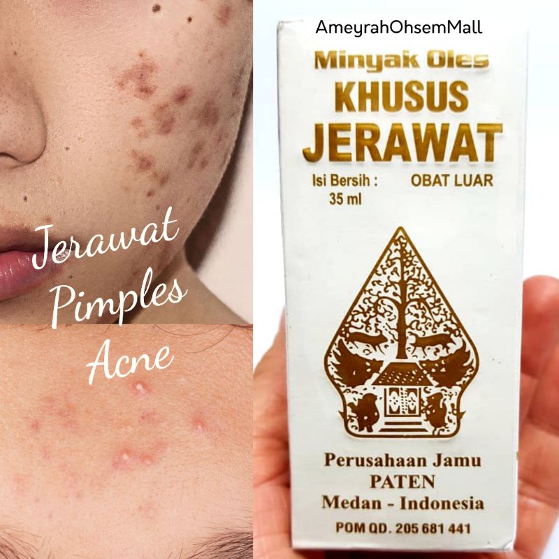 Basmi Jerawat/ Acne/ Pimples Smua Hapus/ Treatment Jerawat/ Sabun ...