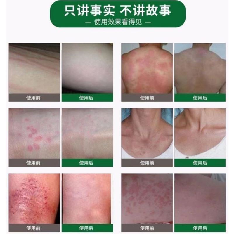 Krim ubat cina lama gatal dubur kesan khas gatal dan gatal losyen badan ...