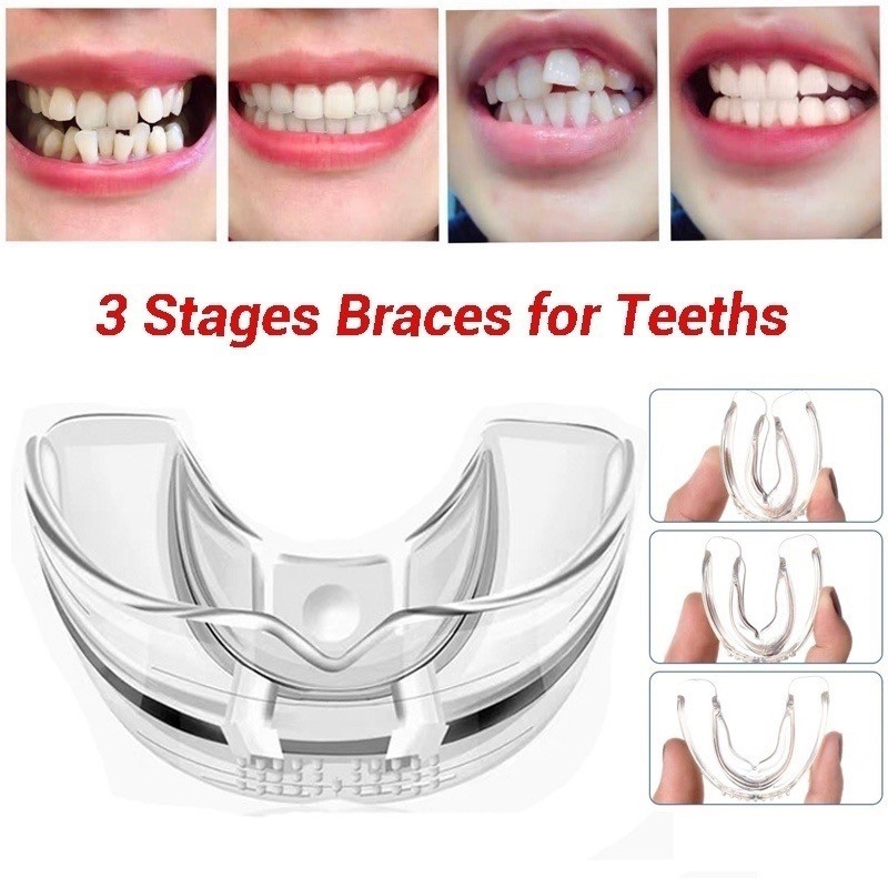Teeth Orthodontic Appliance Alignment Teeth Retainer Bruxism Mouth ...