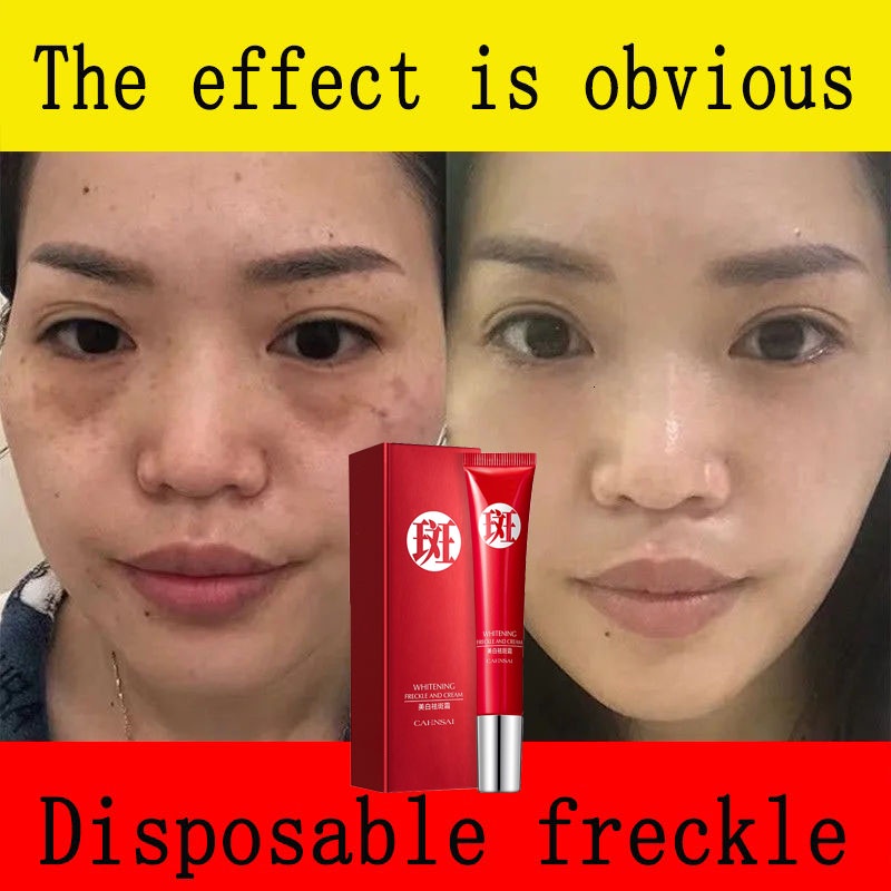 Whitening Freckle Cream Remove Melasma Dark Spots Lighten Melanin Melasma Remover Moisturizing ...
