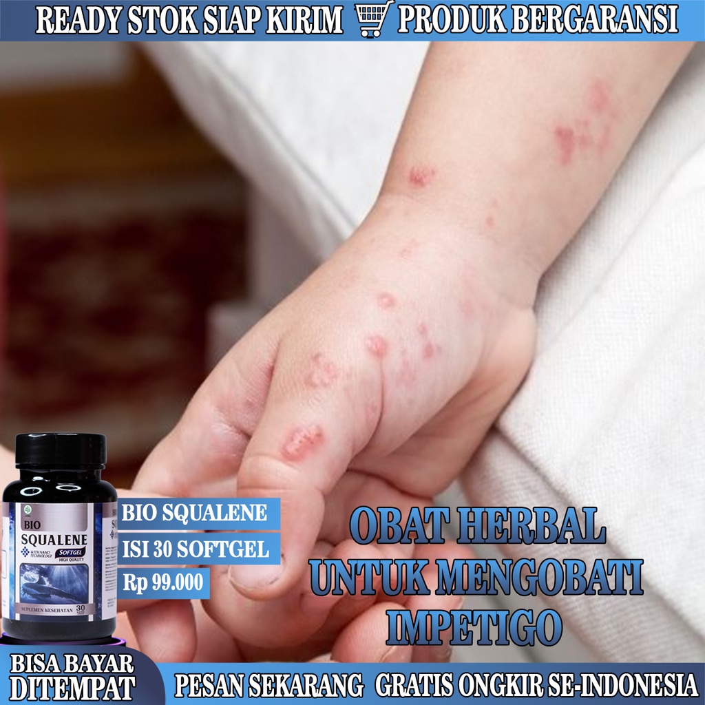 Impetigo Urtikaria Medicines Atopic Eczema Dermatitis Contacts ...