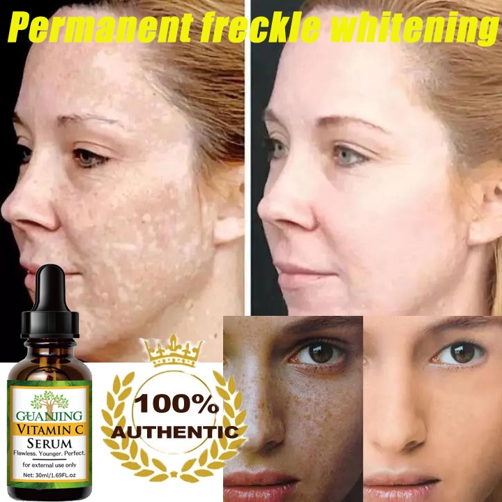 Genuine anti freckle Whitening Serum Moisturizer Remove Freckle Speckle ...