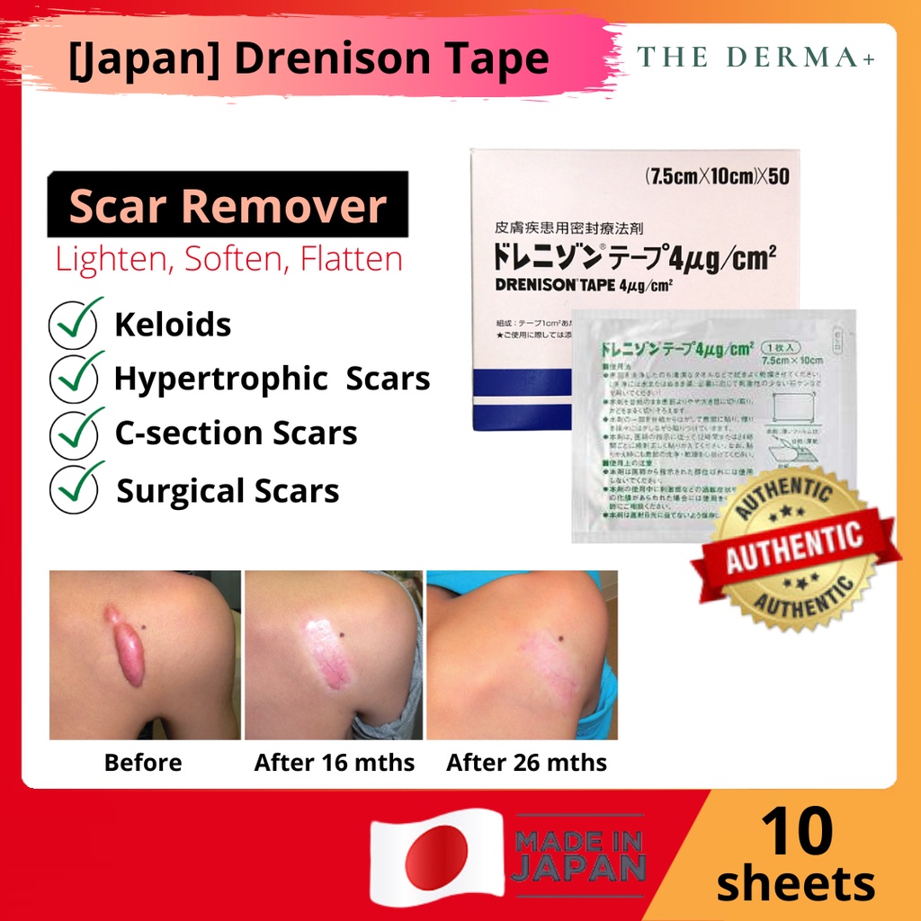 [Japan] Scar Removal / Keloid Treatment - Drenison Plaster Tape ...