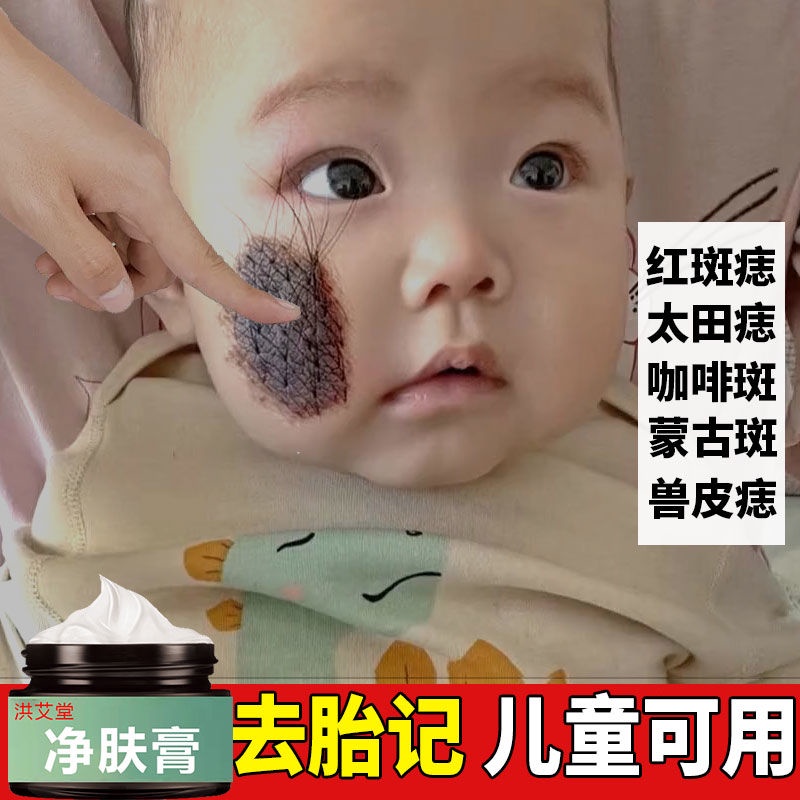 [Ready Stock] [Quick Remove Birthmark] Birthmark Handy Tool Melanin ...