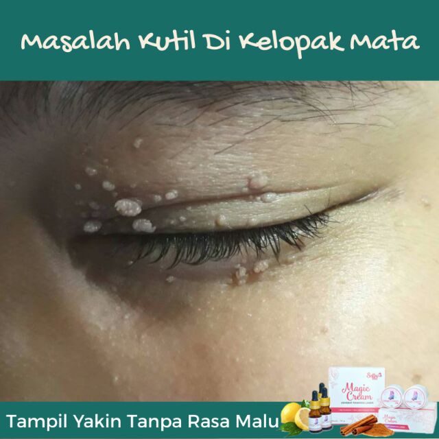 Kutil Kolestrol Di Kelopak Mata / Skin Tag / Biji Kolestrol | Shopee ...