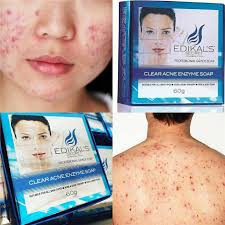 Edikal's Secret Clear Acne & scar Enzyme Soap EDIKAL ESW EXTRA SKIN ...